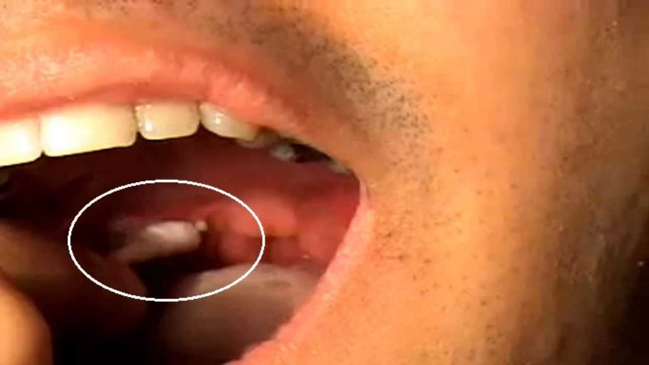 Amandelstenen verwijderen doe je zó | 10 Tips | Amandelstenen? | Top10 ...